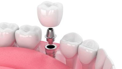 Prótese dentária: conheça os tipos e volte a sorrir!