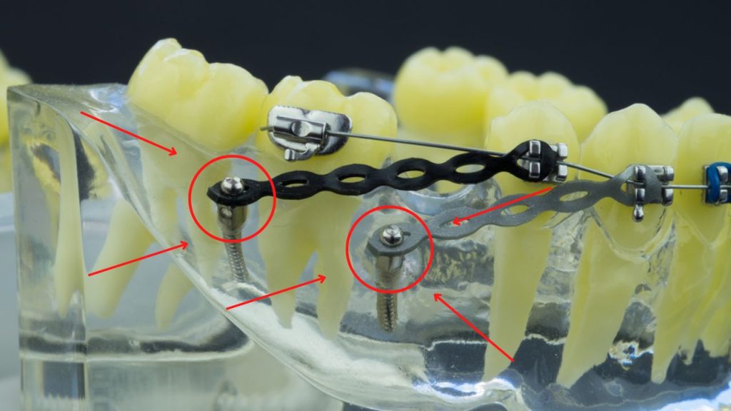 Conheça aqui o que é o mini implante e saiba como funciona