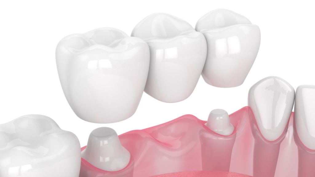 Você sabe qual a melhor prótese dentária fixa? Confira aqui