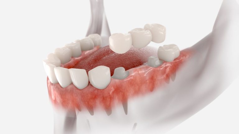 Tipos de prótese dentária: conheça aqui todos os modelos!