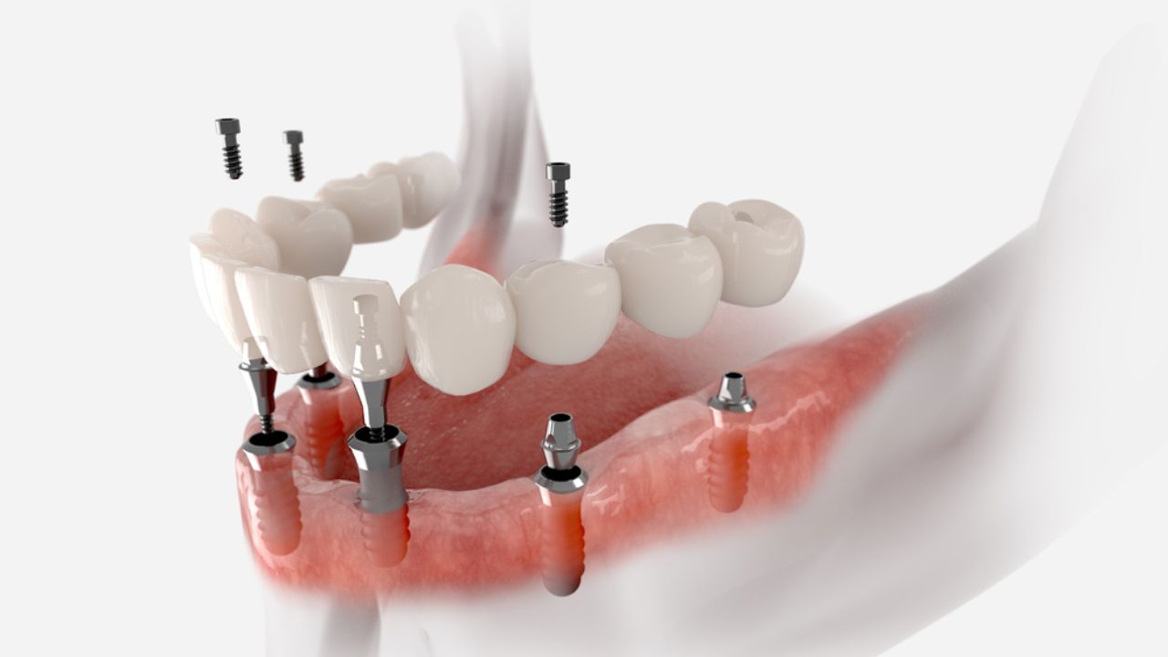 Você sabe qual a melhor prótese dentária fixa? Confira aqui