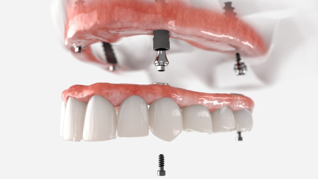 Tipos de prótese dentária: conheça aqui todos os modelos!