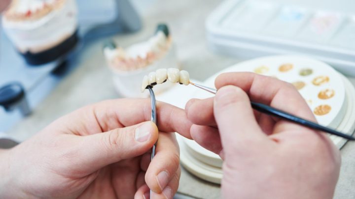 Prótese dentária fixa: conheça os 4 tipos e como funciona