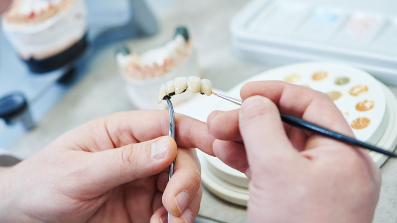 Prótese dentária fixa: conheça os 4 tipos e como funciona