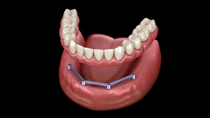 Prótese overdenture: indicações, vantagens e cuidados!