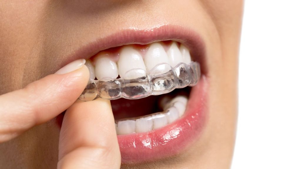 Saiba mais sobre o aparelho transparente e suas vantagens!