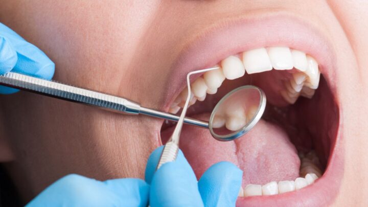 Profilaxia dental: confira o que é, como é feita e benefícios!