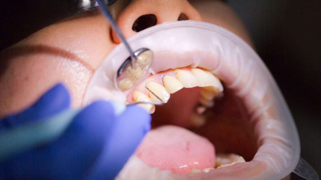 Periodontia o que é? Confira mais sobre essa especialidade!