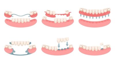 Prótese dentária preço: confira o valor dos principais tipos