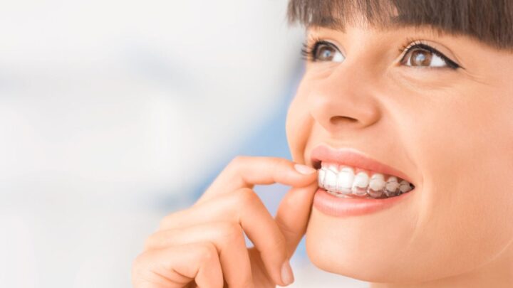 Invisalign preço: veja aqui quanto custa esse tratamento