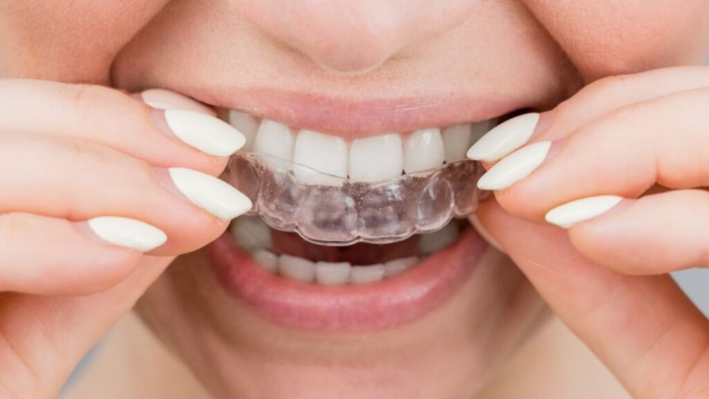 Aparelho invisível: confira o que é e como funciona!