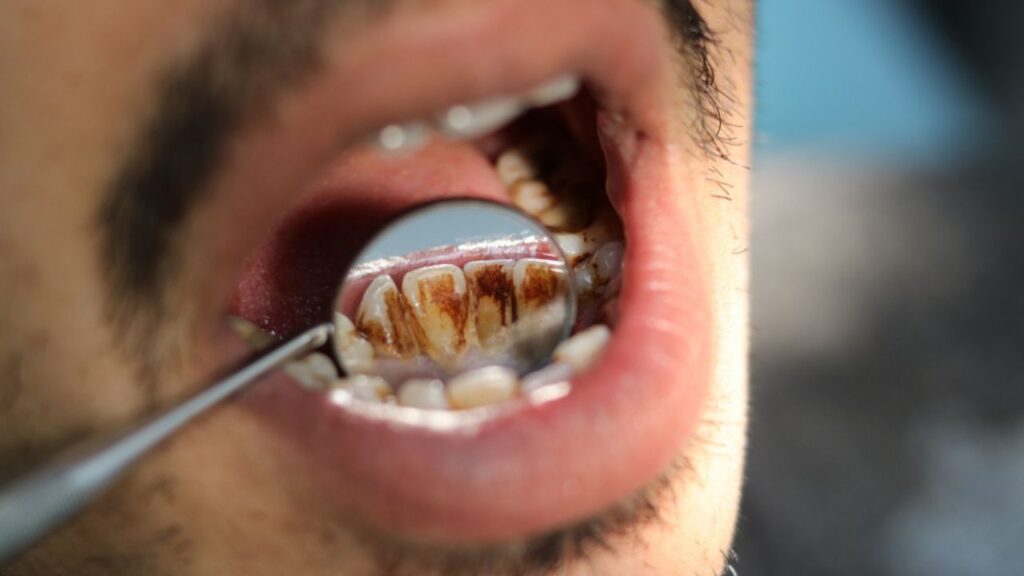 O que é tártaro? Descubra suas causas e tratamento!