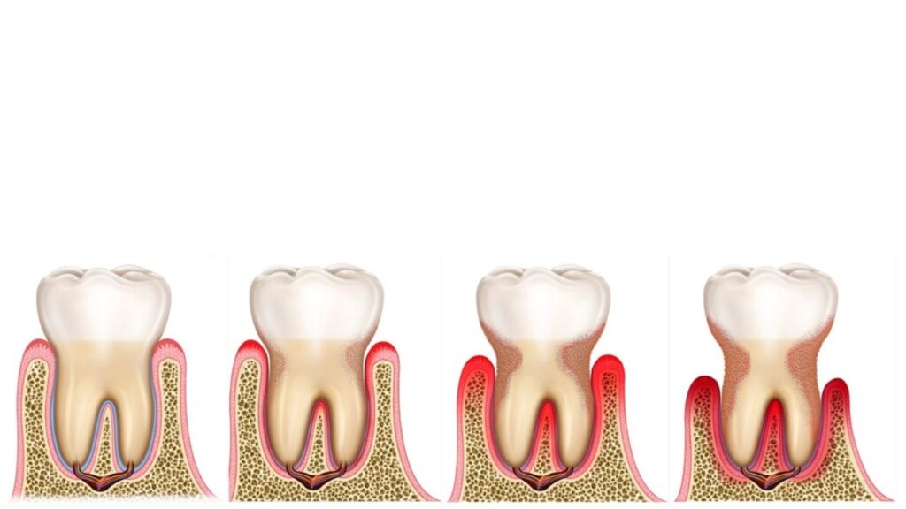 Periodontite: o que é, causas, tratamento e sintomas