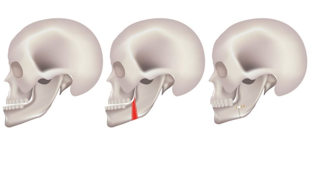 Cirurgia ortognática: veja o que é e como é realizada!