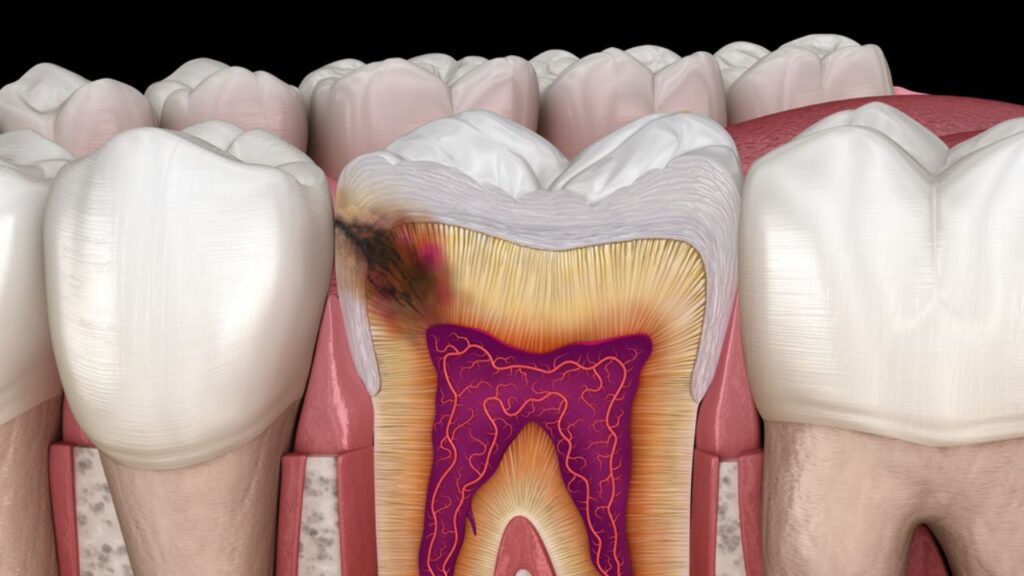 Cárie interproximal: o que é, causas, tratamento e prevenção