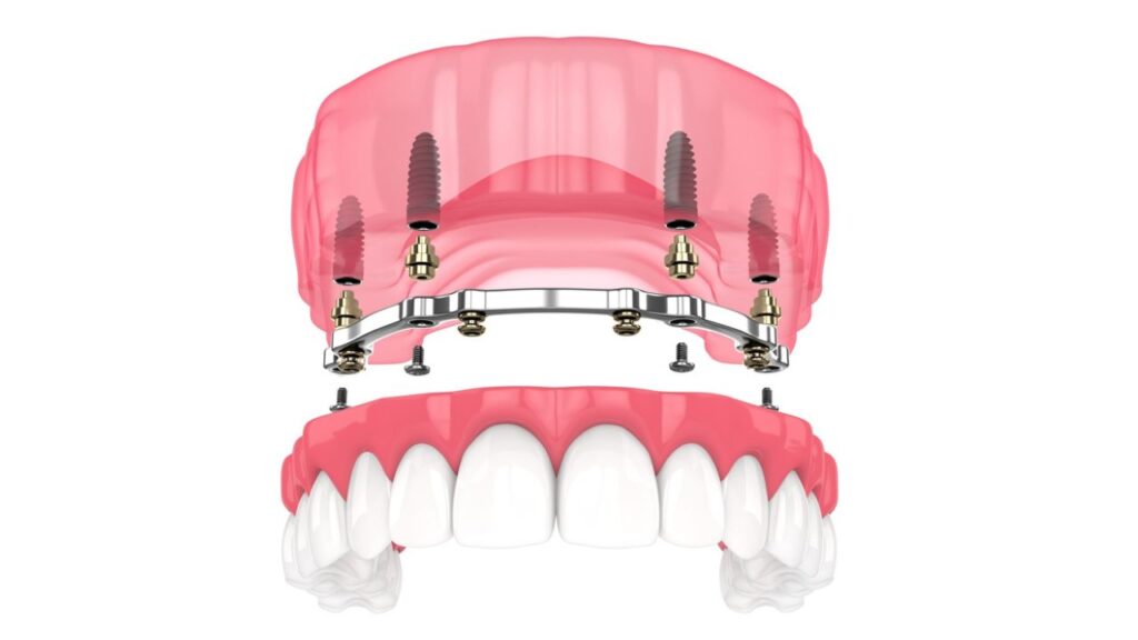 Overdenture superior: o que é e como é feita sua fixação!