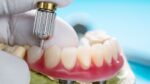 Overdenture inferior: confira mais a respeito dessa prótese!