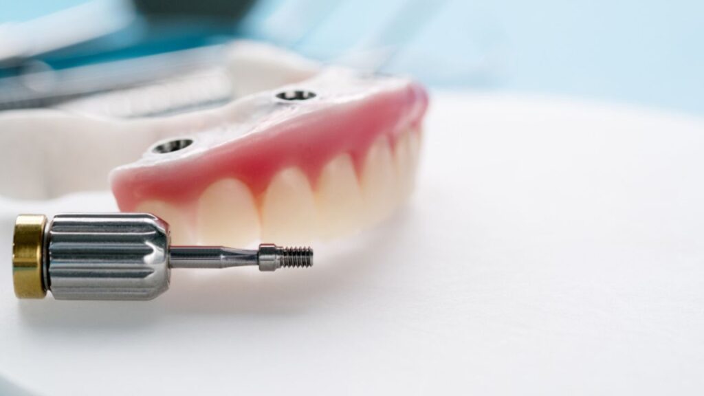 Prótese overdenture: indicações, vantagens e cuidados!