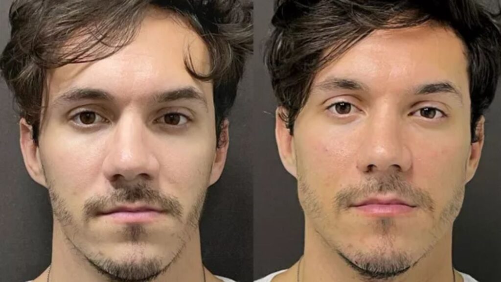Harmonização facial masculina: benefícios e antes e depois!