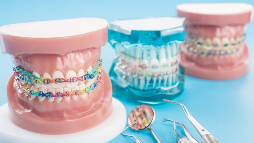 Cores de aparelho de dente: saiba como escolher e manter as cores!