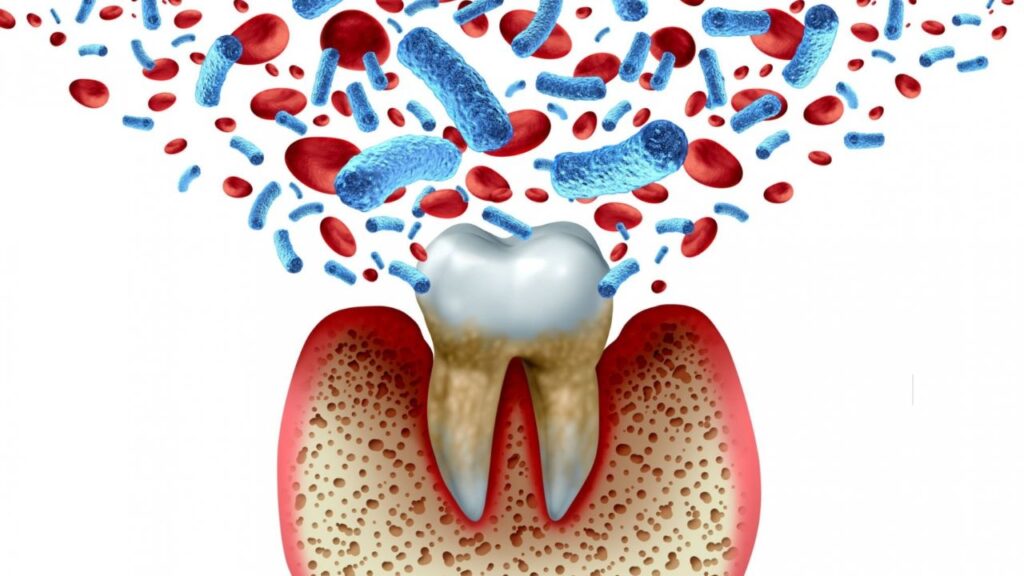 Doença periodontal: o que é, causas, sintomas e tratamento!