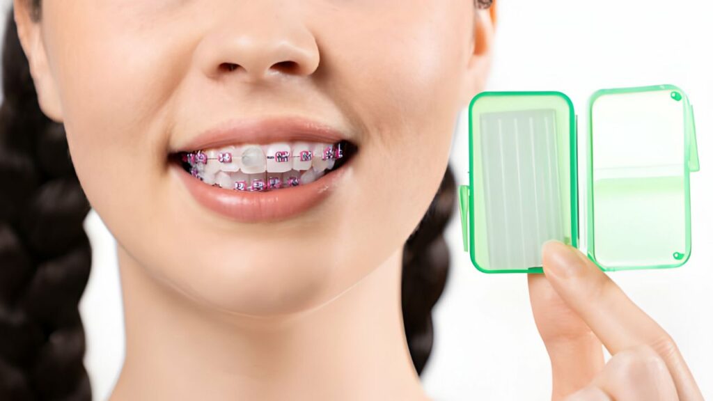 Cera ortodôntica: aprenda como usar e retirar o produto!