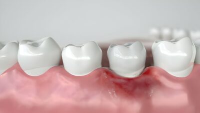 Está com dente inflamado? Saiba como tratar e aliviar a dor!