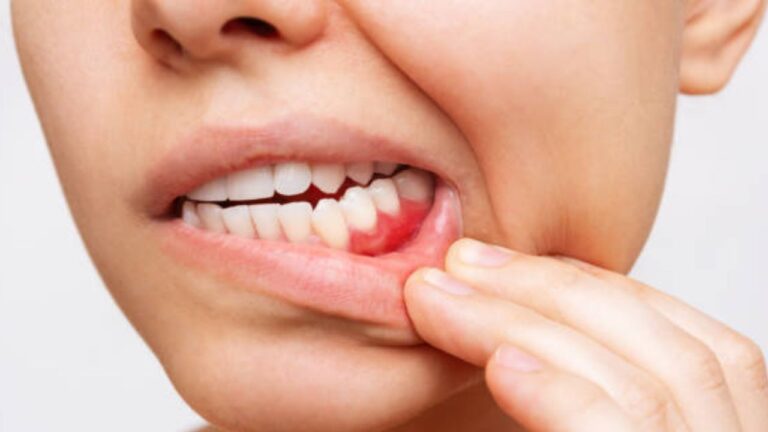 Qual o melhor antibiótico para dente inflamado? Saiba aqui!