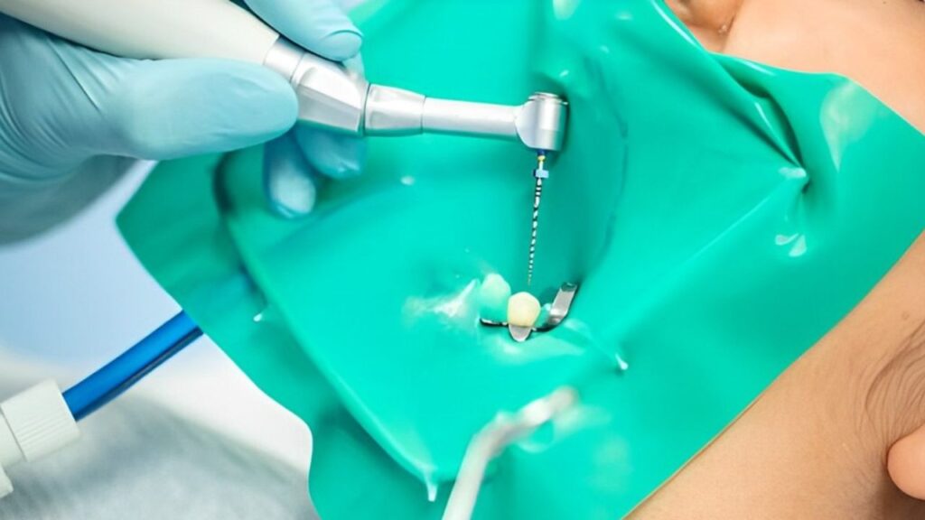 Canal no dente antes e depois: saiba os principais cuidados!