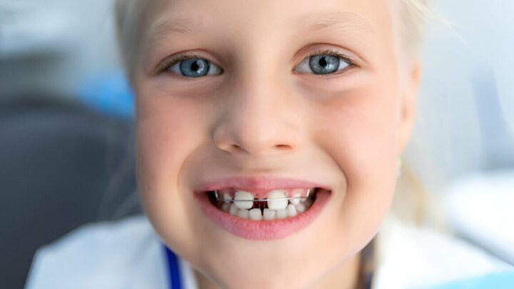 Diastema dente: guia completo sobre o assunto aqui!