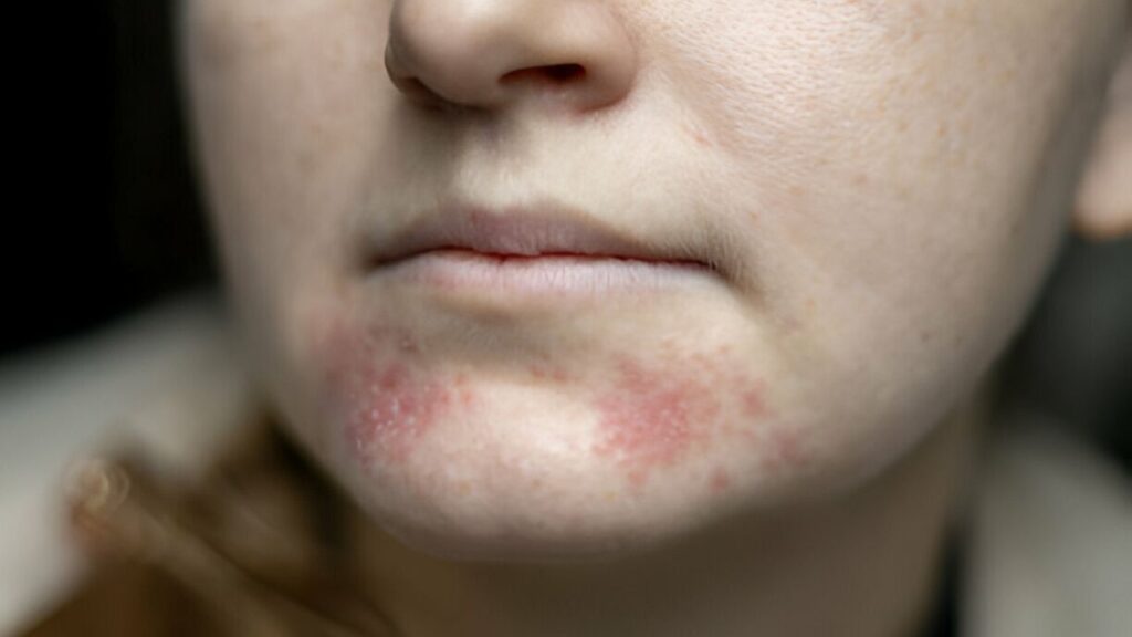 Sintomas de dermatite perioral: saiba identificar e tratar!