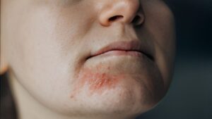 Dermatite Perioral Tratamento: saiba como cuidar!