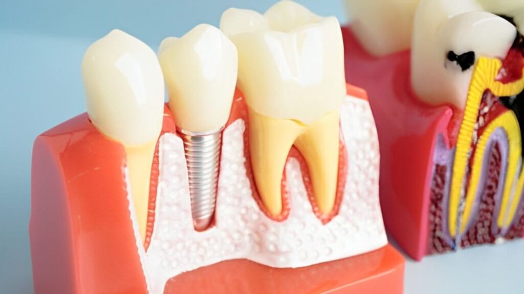 Próteses Dentárias: guia completo sobre o tratamento!