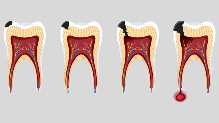 Tipos de cárie: descubra quais são! - OralDents