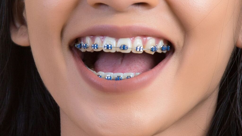 Aparelho ortodôntico estético: confira os principais modelos!
