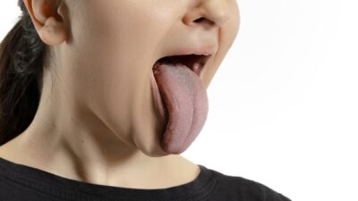 Língua fissurada: entenda o que é e suas causas - OralDents