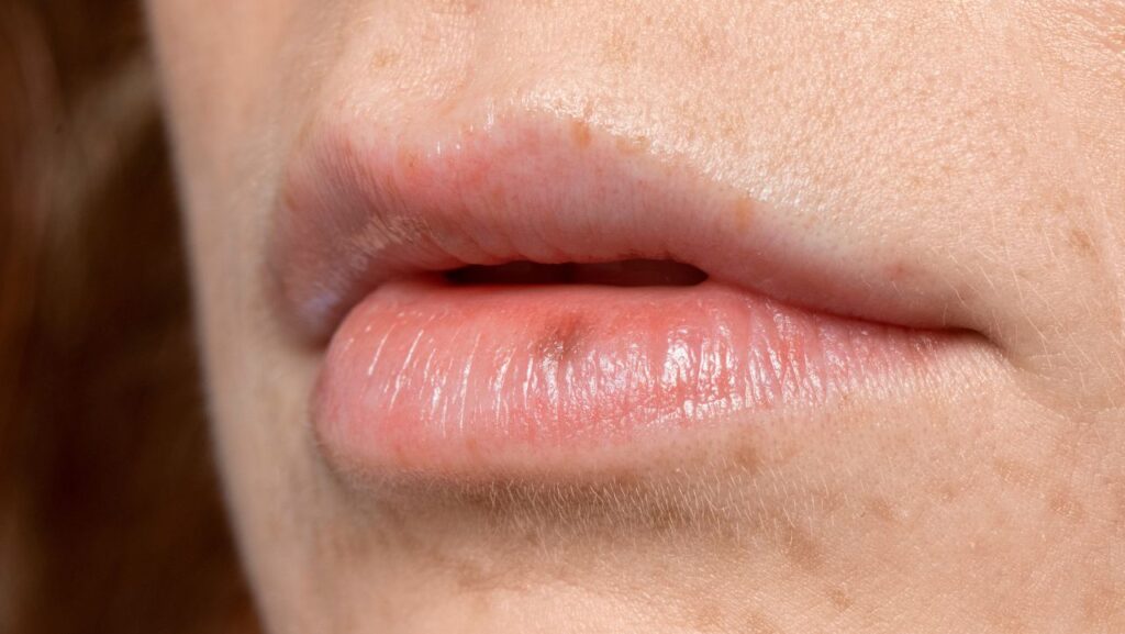 Manchas brancas na boca: o que pode ser? - OralDents