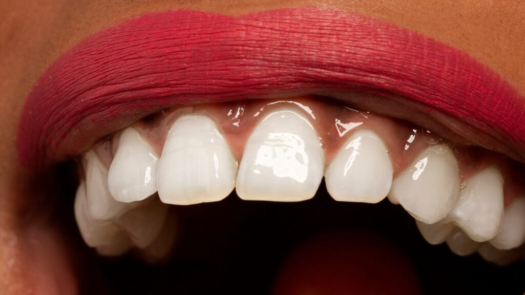 Doenças na gengiva: entenda quais são - OralDents