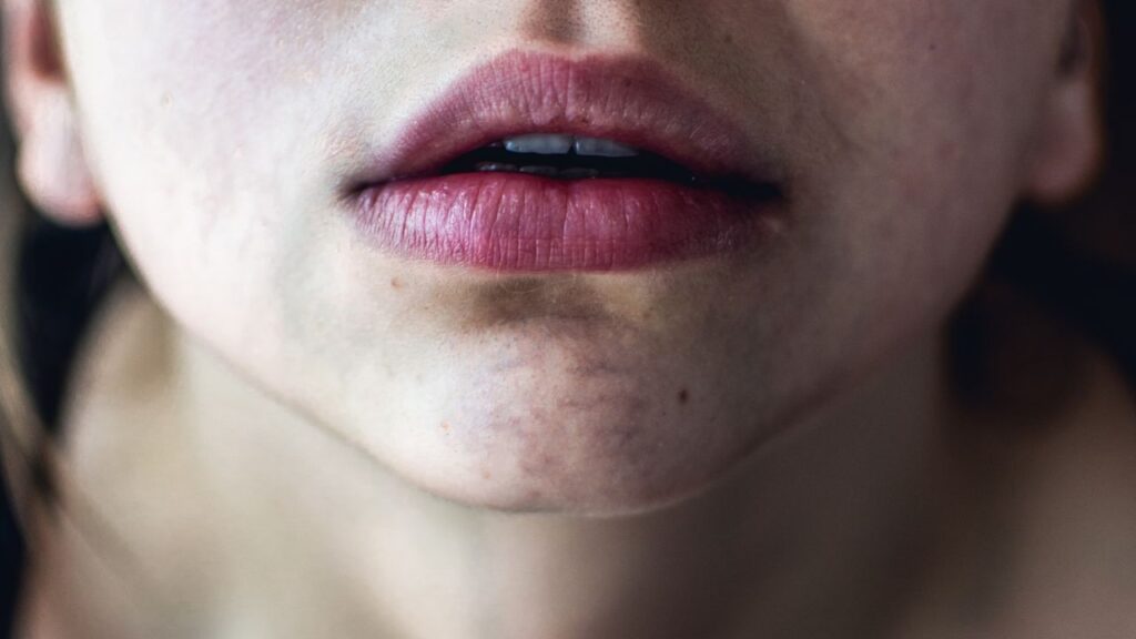 Micose na boca: o que é, causas e tratamentos - OralDents