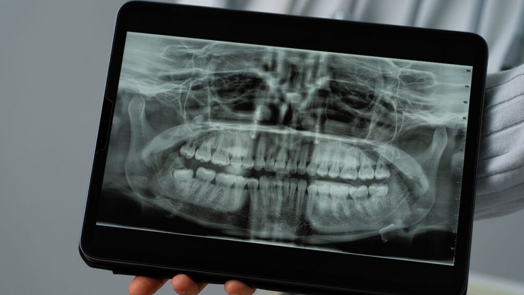 Raio X odontológico: tipos, benefícios e indicações