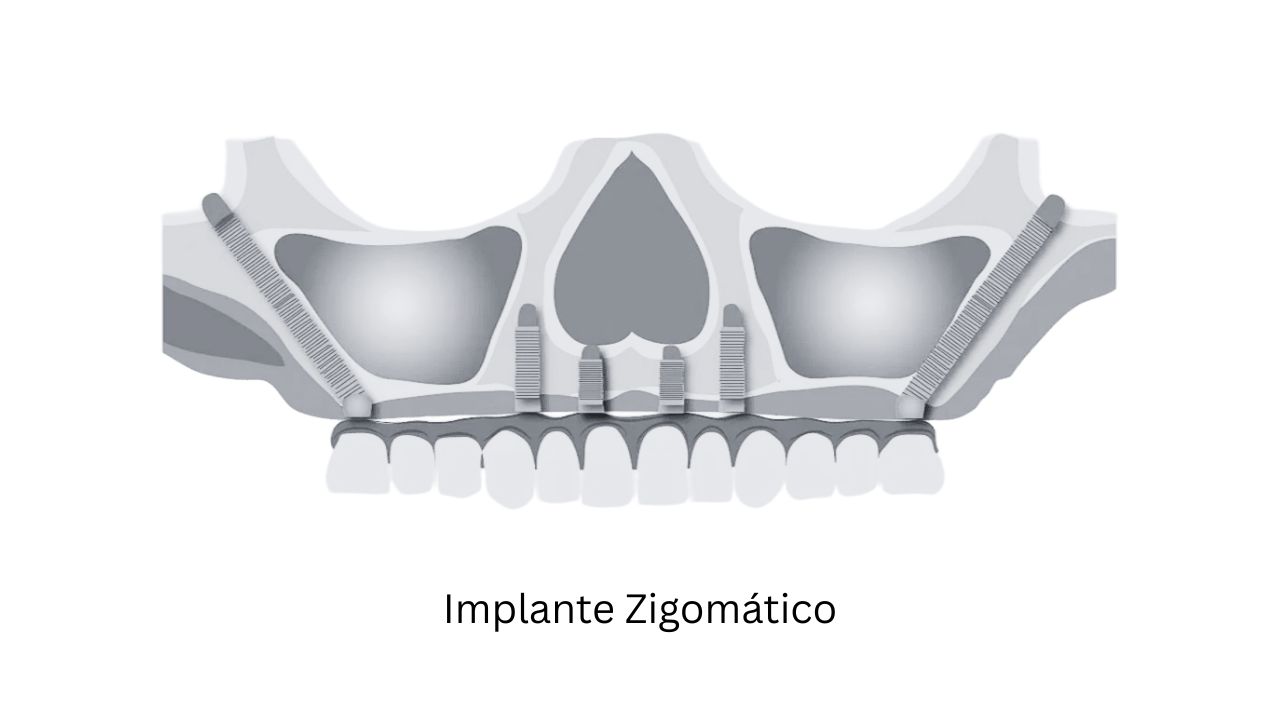 Implante Zigomático: saiba tudo sobre o tratamento!