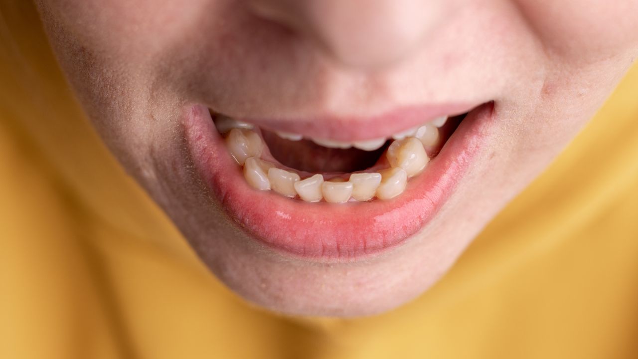 Dentes desalinhados: causas, impactos e tratamentos