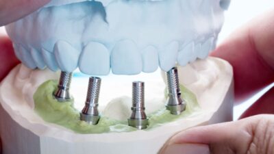 Implante Zigomático: saiba tudo sobre o tratamento!