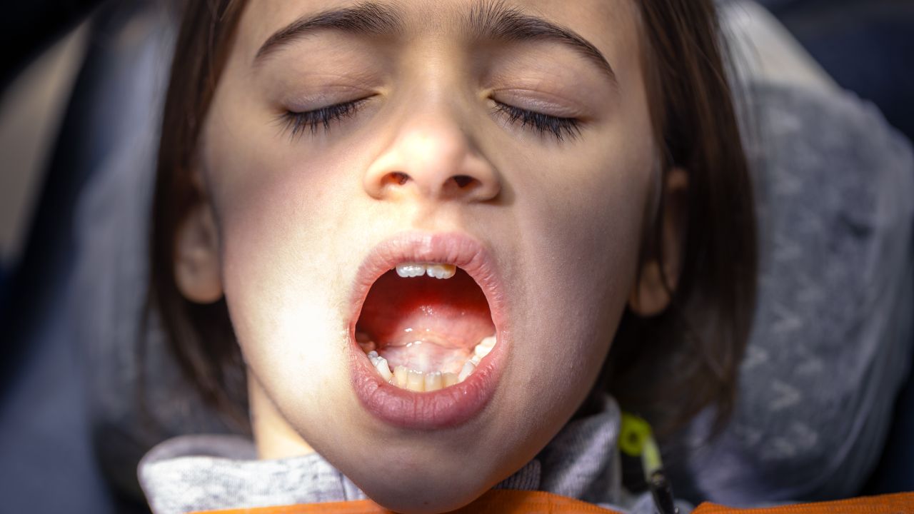 Dente incluso: sintomas, causas e tratamentos - OralDents