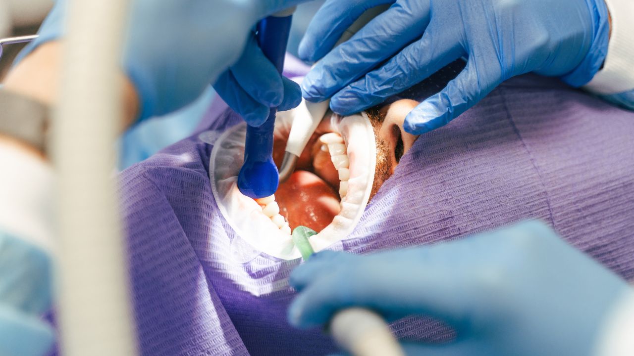 Coronectomia: uma alternativa à extração de dentes do siso